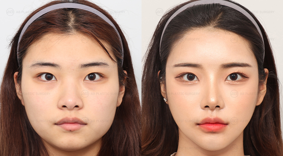 Korea Plastic Surgery Before & After | Bệnh viện thẩm mỹ AB